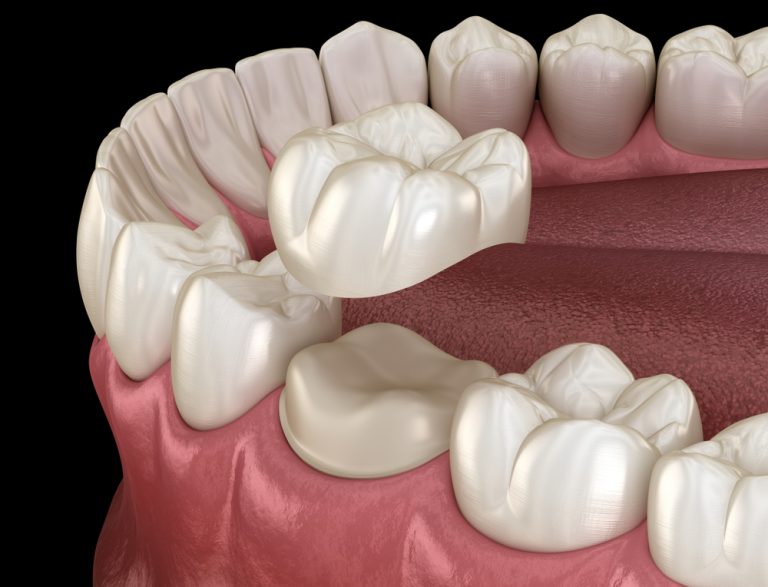 Do Dental Crowns Look Like Real Teeth? Find Out Now!